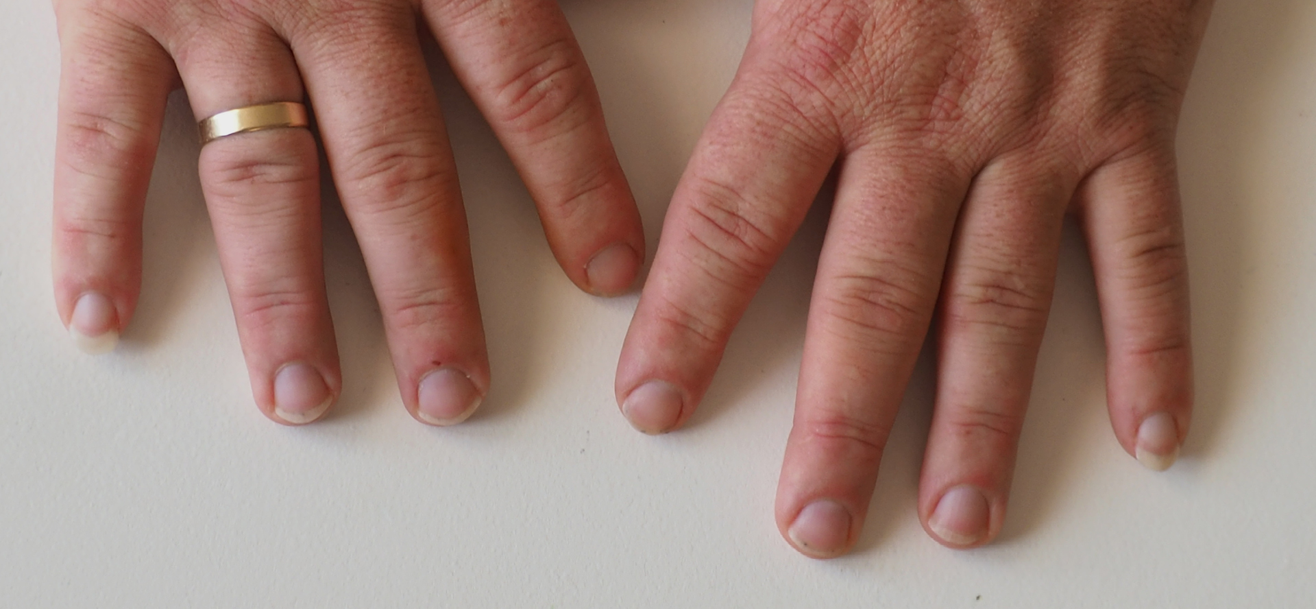 Wat je allemaal moet weten over acromegalie | Pfizer