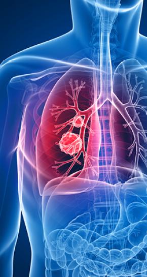 Wat is longkanker? | Pfizer