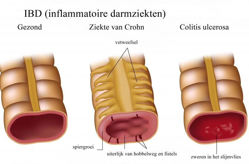 Leven met IBD, een chronische darmziekte | Pfizer