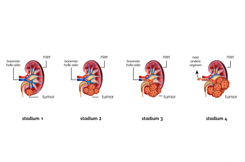 Wereldwijd aandacht voor nierkanker én bewegen | Pfizer